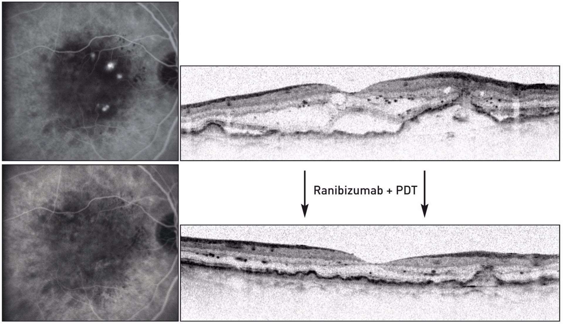 Vasculopathie polypoïdale : quel traitement en 2012? - cahiers ...