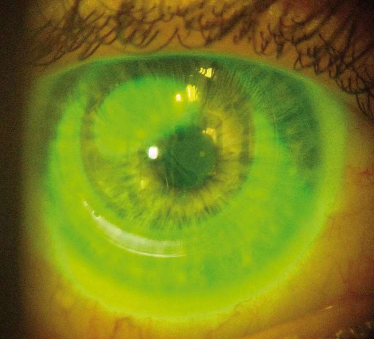 Kératocône et lentille hybride