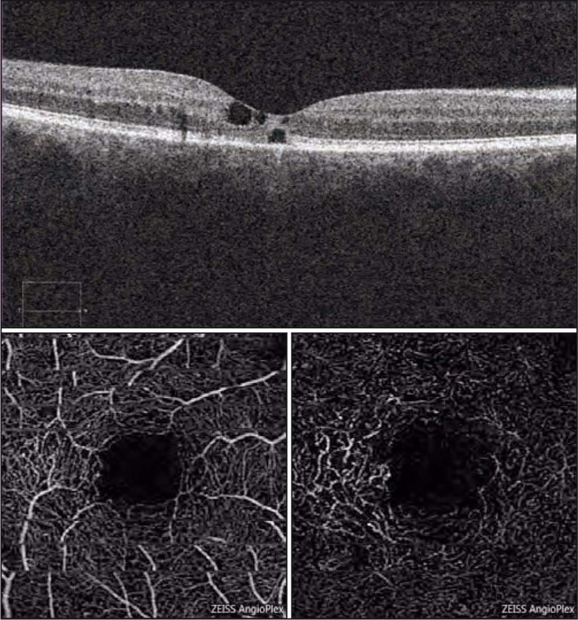 Quand l’œdème maculaire ne diffuse pas