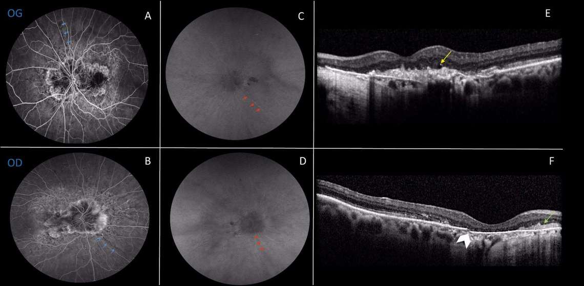 Des stries angioïdes néovascularisées