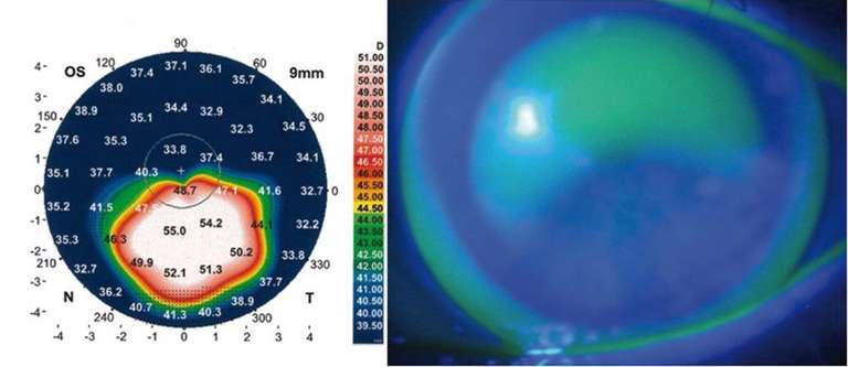 Principales clés d’adaptation en lentilles d’un kératocône