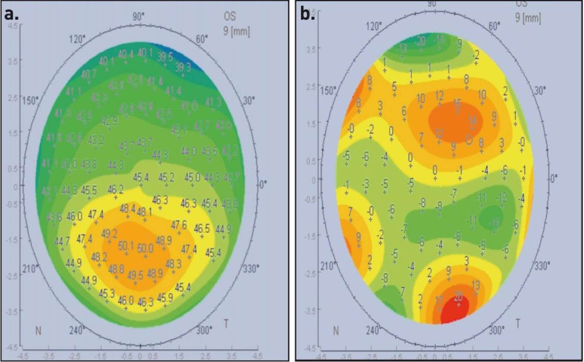 Une topographie peut en cacher une autre... - cahiers-ophtalmologie