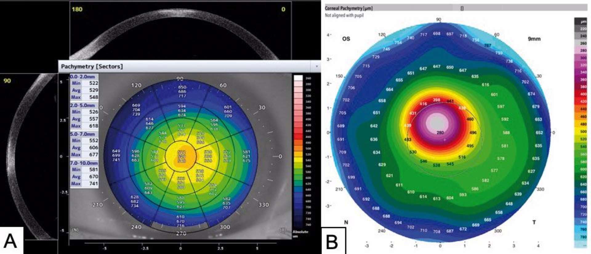 Topographie OCT : un nouveau standard ? - cahiers-ophtalmologie