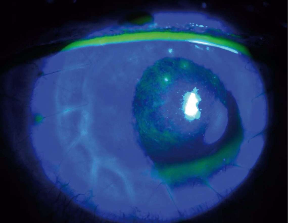 Kératoplastie et surface oculaire