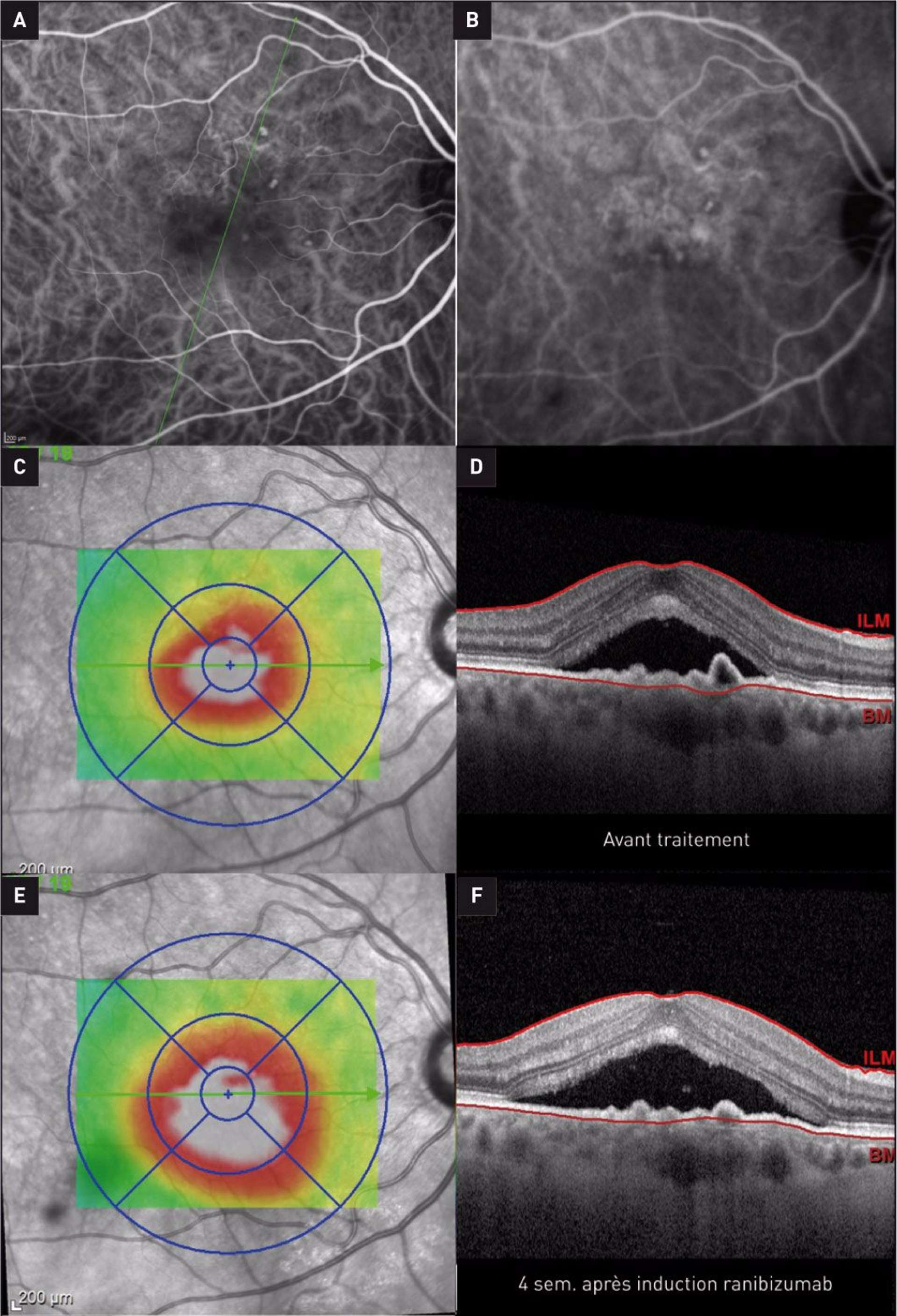 DMLA - cahiers-ophtalmologie