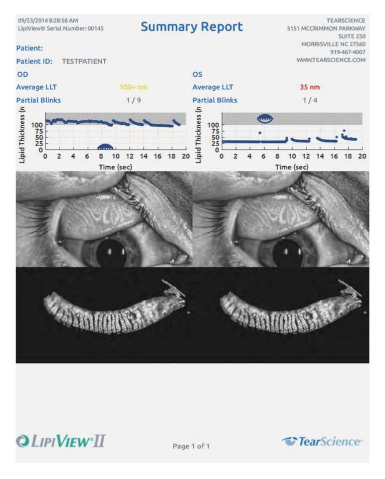Préparation de la surface oculaire à la chirurgie de la cataracte