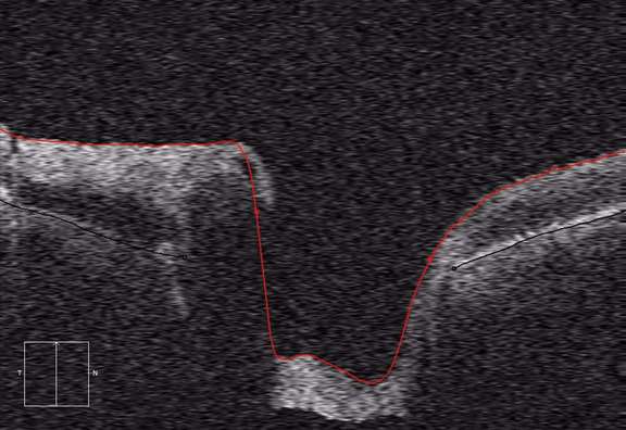 Analyser un OCT de la papille