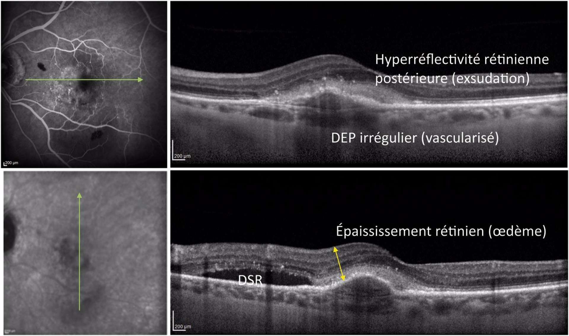 "En Face" OCT et DMLA - cahiers-ophtalmologie