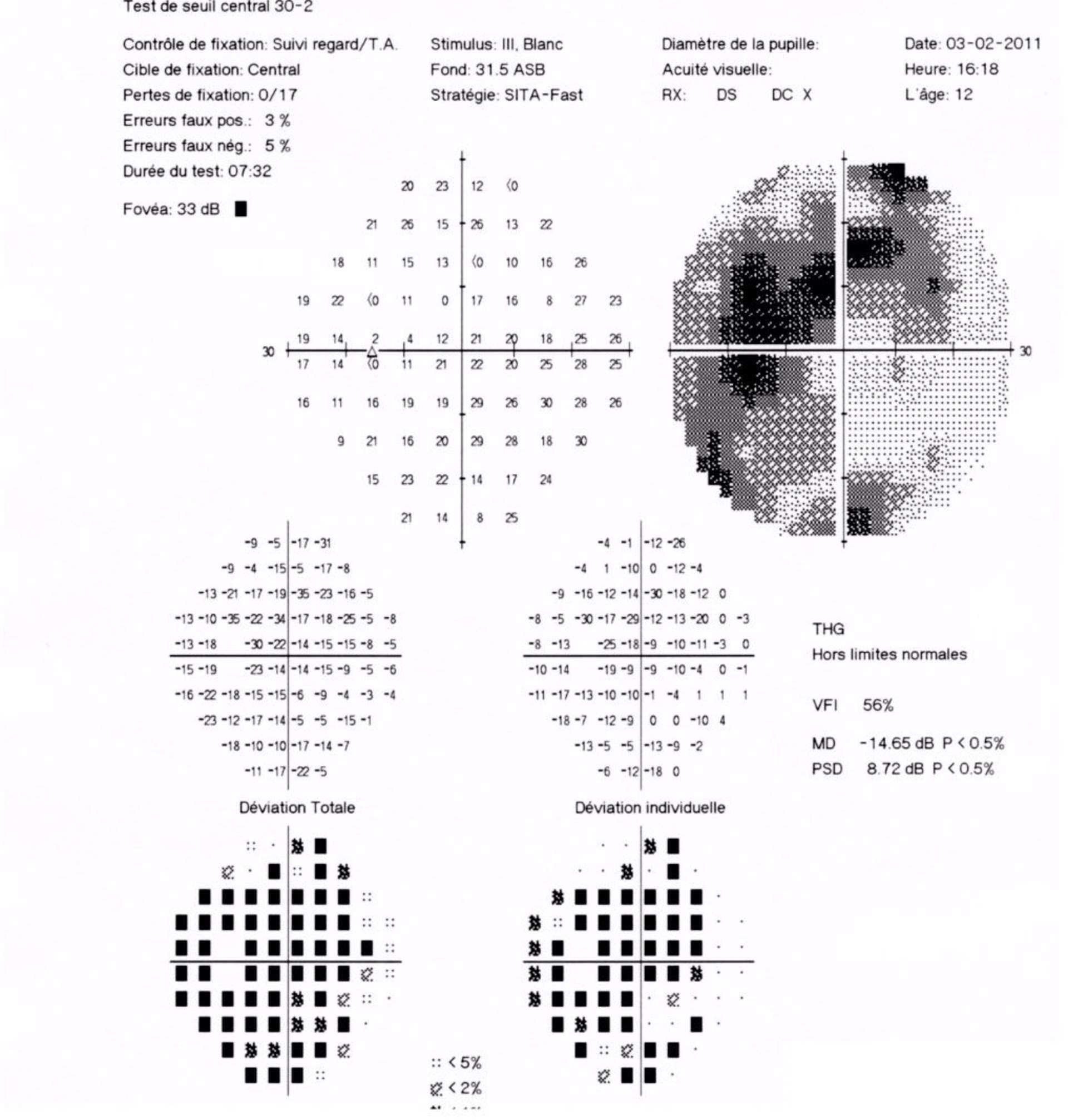 Prescrire et interpréter un champ visuel en neuro-ophtalmologie ...