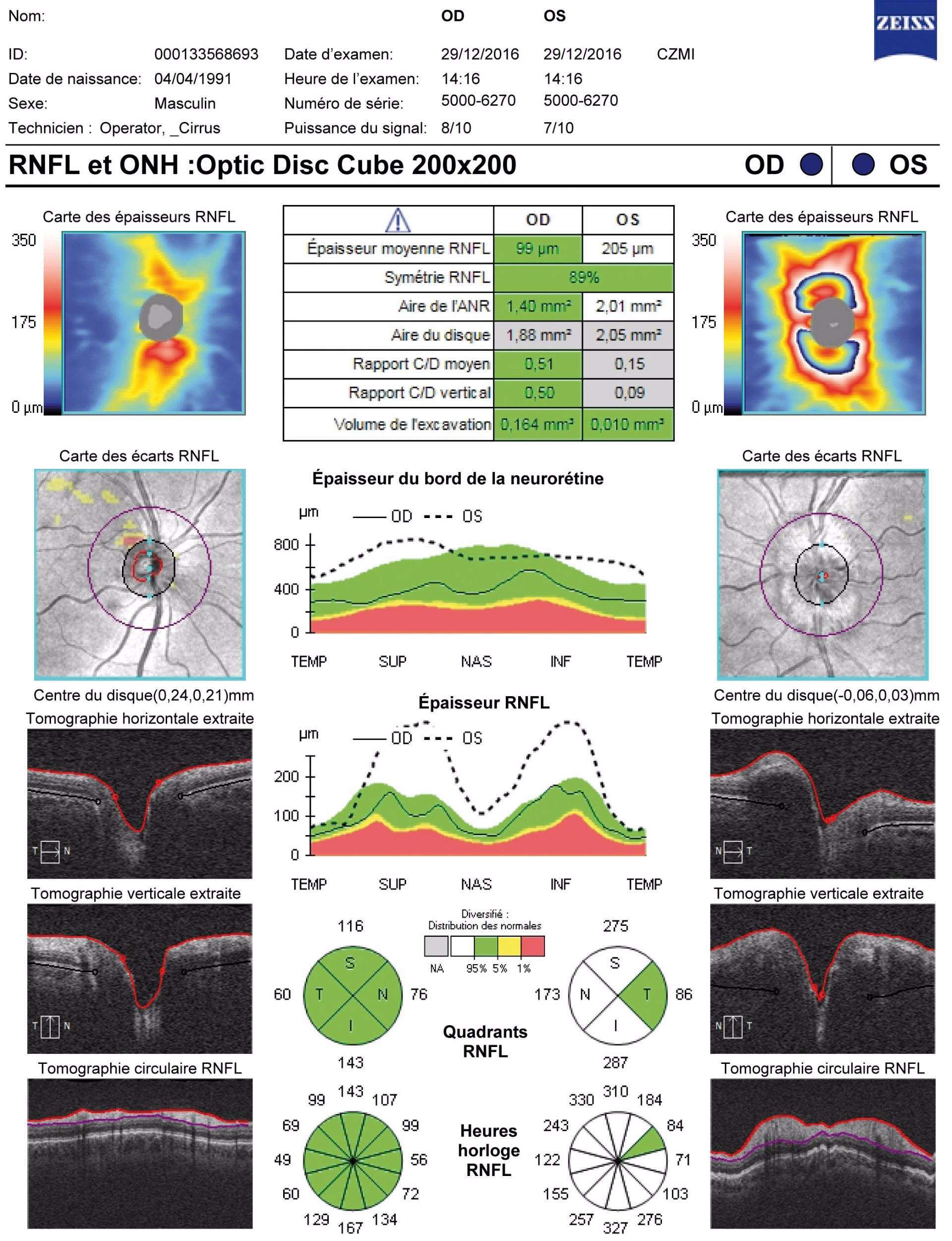 Neuropathie optique à anticorps anti-MOG - cahiers-ophtalmologie