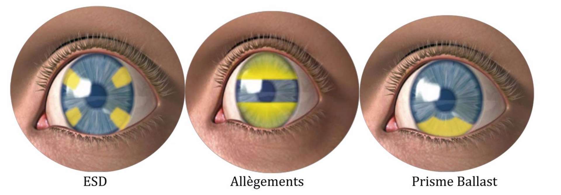 Lentilles souples en pratique - cahiers-ophtalmologie