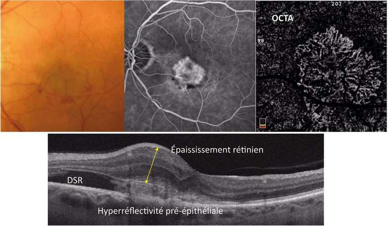 DMLA exsudative : les 10 signes à connaître en OCT