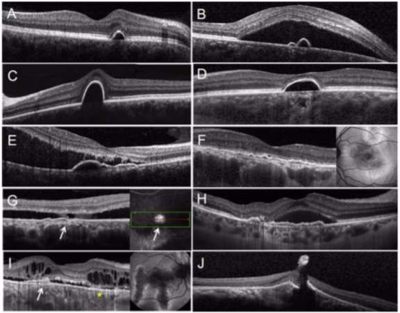 Nouveautés en physiopathologie et imagerie de la CRSC