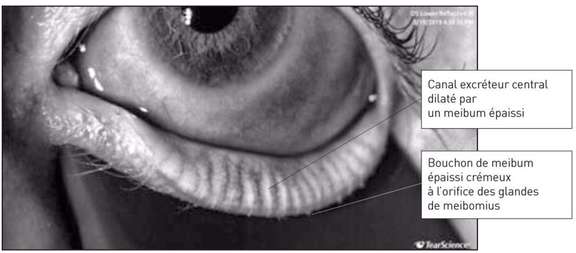 Focus sur les glandes de Meibomius