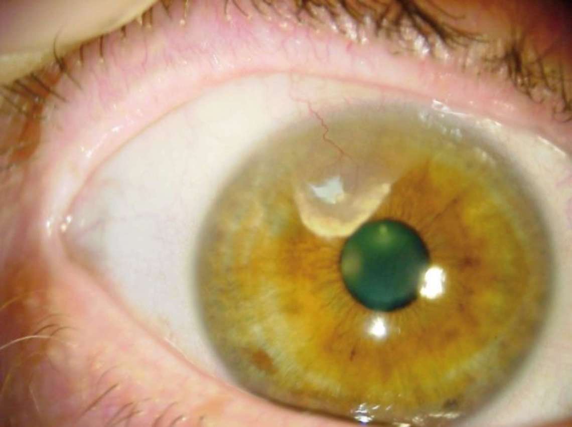 Zona ophtalmique : signes cliniques à court et moyen terme