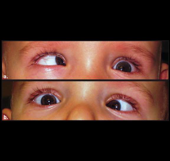 Les opérations du strabisme : qui, quand et comment? (2e partie)