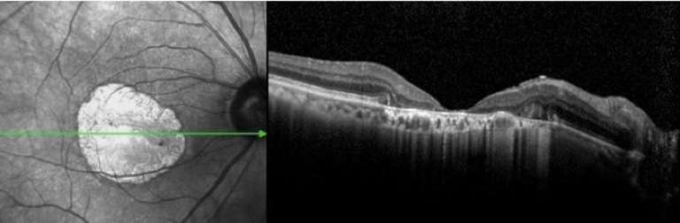 Espoirs et échecs dans le traitement de la DMLA atrophique