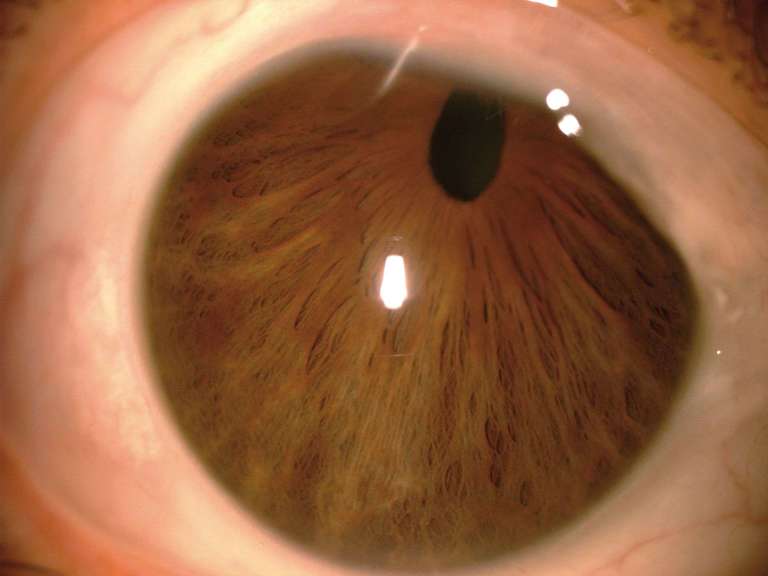 Atteinte cornéenne du glaucome congénital - cahiers-ophtalmologie