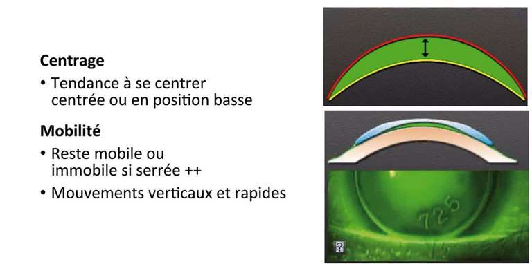 Principes d’adaptation d’une lentille cornéenne rigide perméable au gaz ...