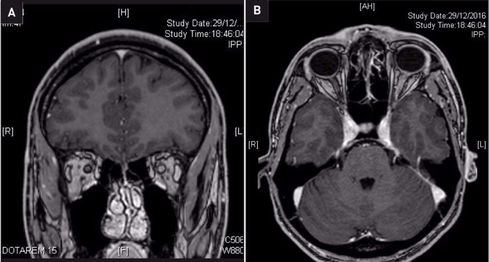 Neuropathie optique à anticorps anti-MOG - cahiers-ophtalmologie