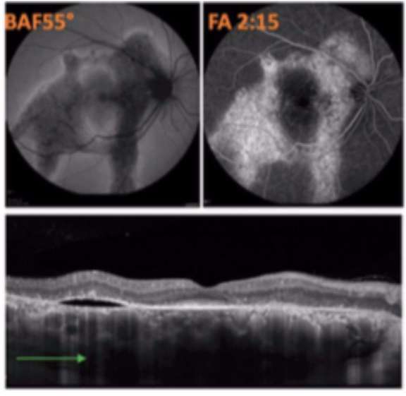 Nouveautés en physiopathologie et imagerie de la CRSC