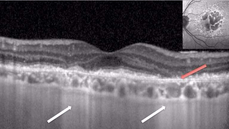 DMLA : les 10 signes à l’OCT qu’il faut connaitre - cahiers-ophtalmologie