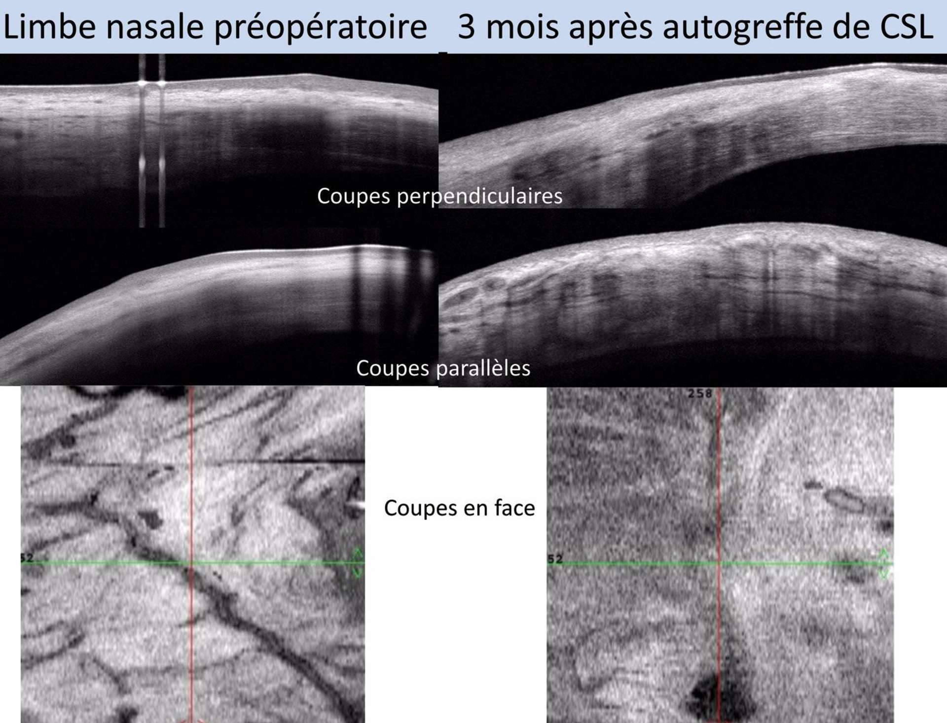 Où en est-on de la greffe de cellules souches limbiques ? - cahiers ...