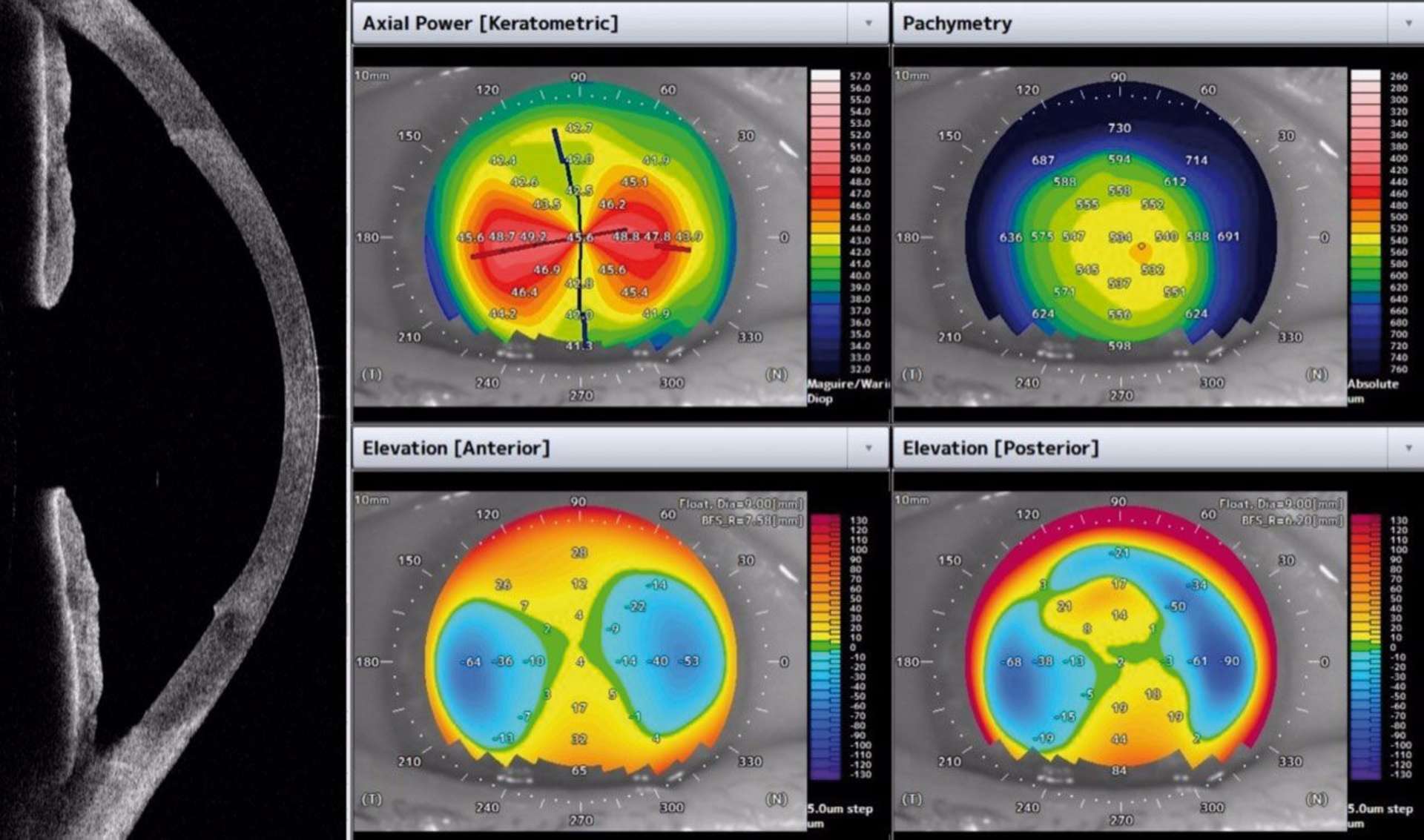 Topographie OCT : un nouveau standard ? - cahiers-ophtalmologie