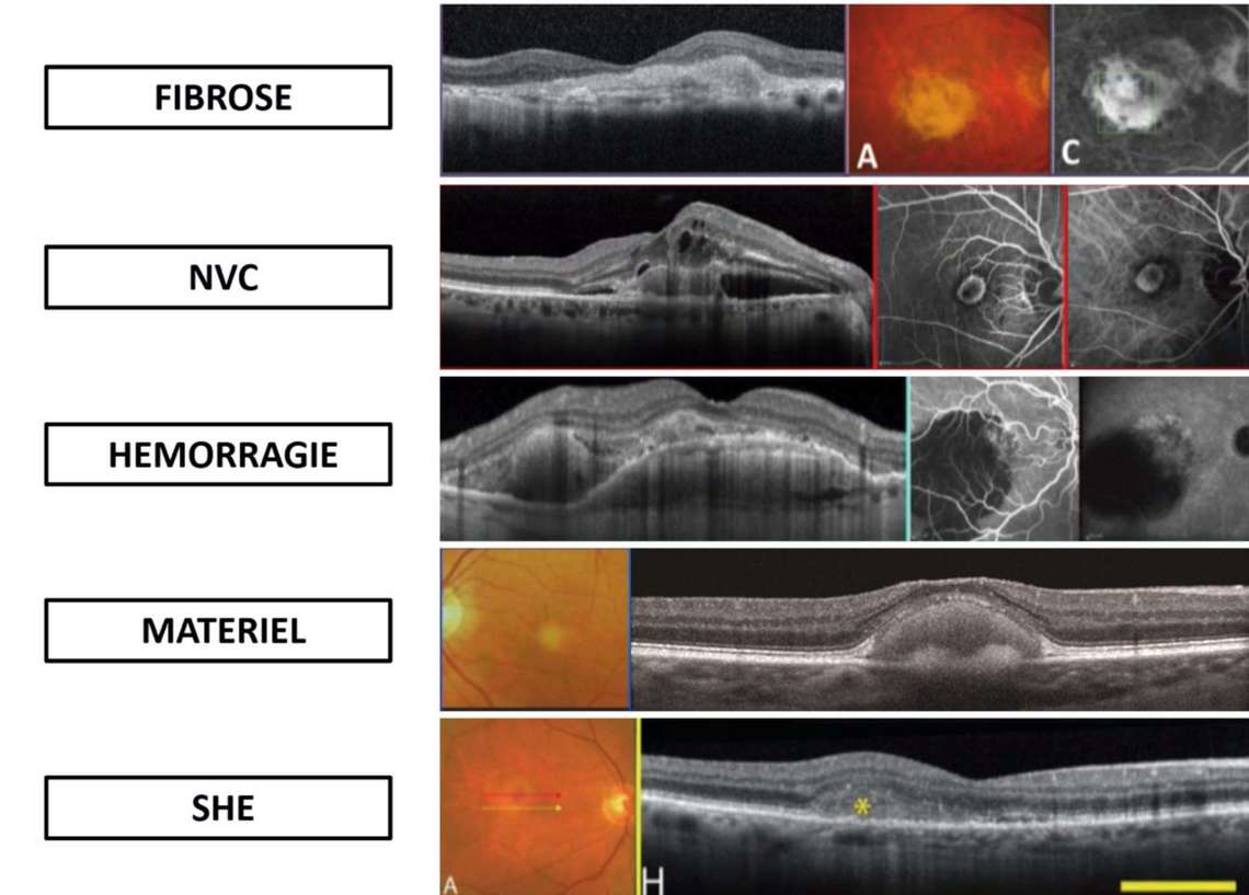 La rétine en pratique 2020