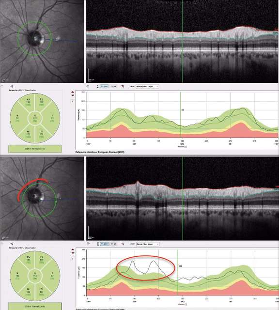 OCT pour le diagnostic d’un glaucome