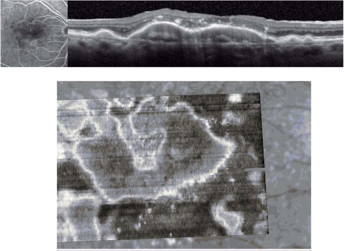"En Face" OCT et DMLA