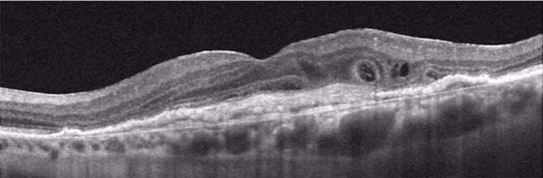 DMLA exsudative : les 10 signes à connaître en OCT